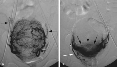Uterine Fibroid Embolization Vs Hysterectomy Ecco End