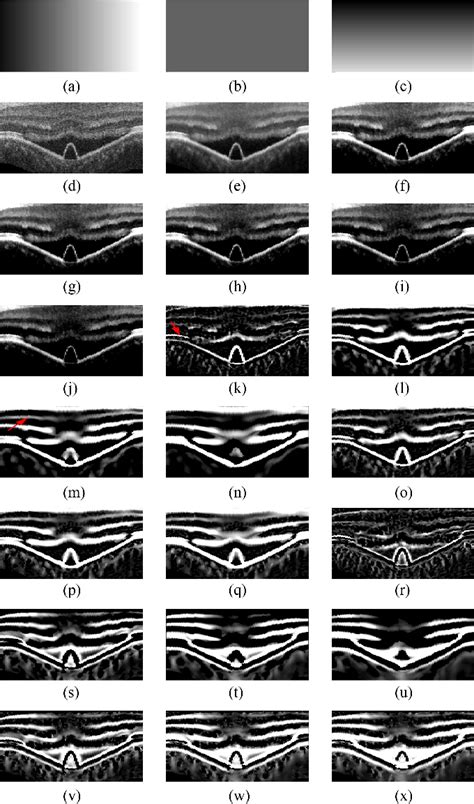 Figure 3 From Automatic Retinal Layer Segmentation Of Oct Images With Central Serous Retinopathy