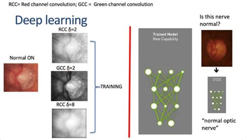 Deep Learning System For Detection Of Glaucomatous Optic Disc Using Download Scientific Diagram