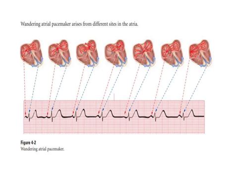 Atrial Dysrhythmias And How To Interpret In Ecg Pptx