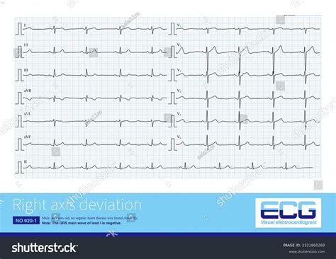 88 Ecg Right Axis Deviation Images Stock Photos Vectors Shutterstock