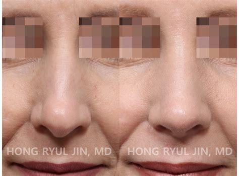 Creating More Feminine Nose