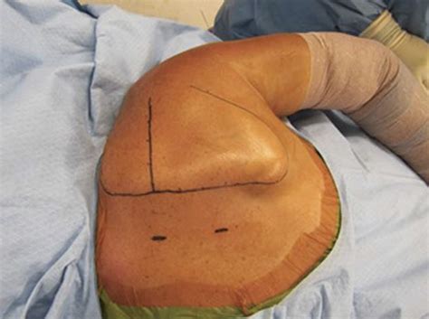 Arthroscopic Scapulothoracic Bursectomy Salt Lake City West Valley West Jordan