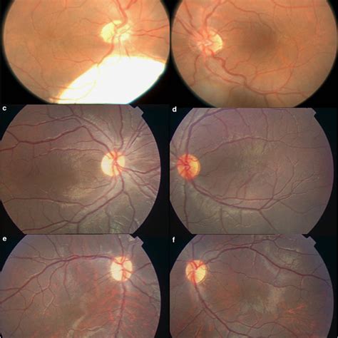 Fundus Photographs Of The Three Cases A And B Are The Fundus