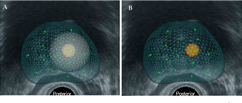 Figure 1 From Perilesional Targeted Biopsy Combined With Mri Trus Image Fusion Guided Targeted