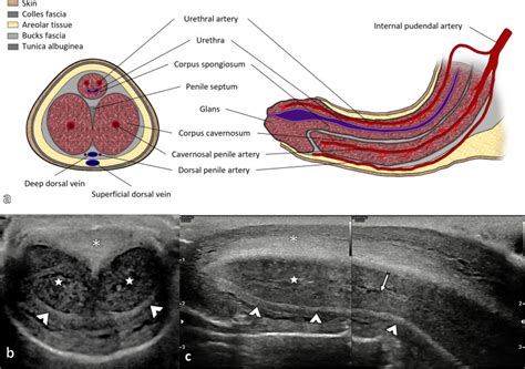 Utility Of Contrast Enhanced Ultrasound Ceus In Penile Trauma Pmc