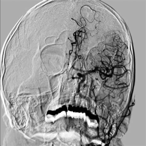 The Dsa Of The Left Carotid Artery Revealed Restoration Of Flow To The Download Scientific