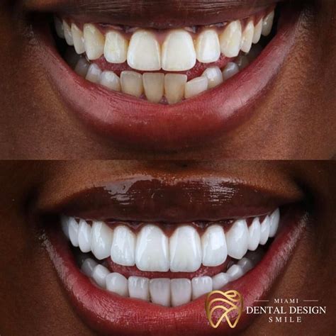 Get Up To 1000 Off On Veneers Miami Design Smile Miami
