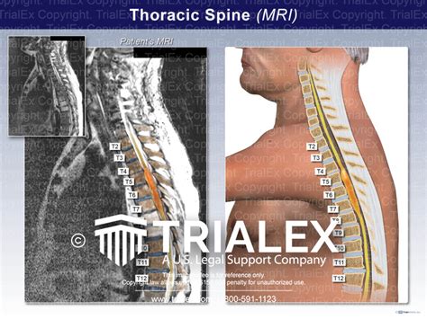 Thoracic Spine Mri