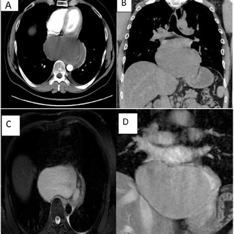A Ct Scan Chest Showing Large Cystic Mass With Severe Compression On