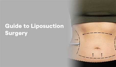 Guide To Liposuction Surgery