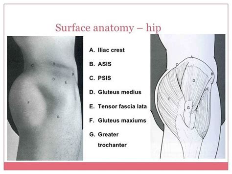 Psis Surface Anatomy Pelvis Anatomy Recon Orthobullet