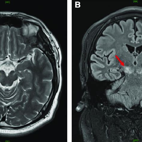 Brain Magnetic Resonance Imaging Of The Right Midbrain In T2 Weighted Download Scientific