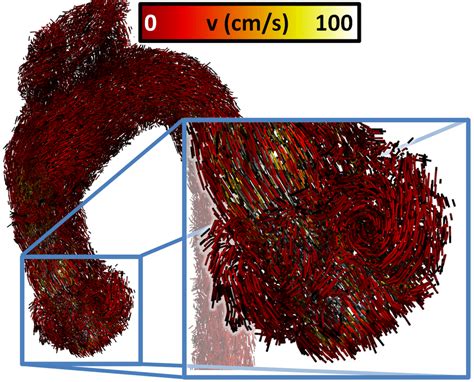 11 Measured Flow In The Aorta Vortices Can Be Seen In The Aorta Root