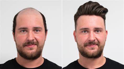 Men S Hair Replacement Alternatives Best Men Haircuts