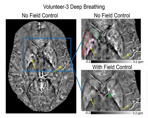 Pdf Enhanced Quantitative Susceptibility Mapping Qsm Using Real Time Field Control