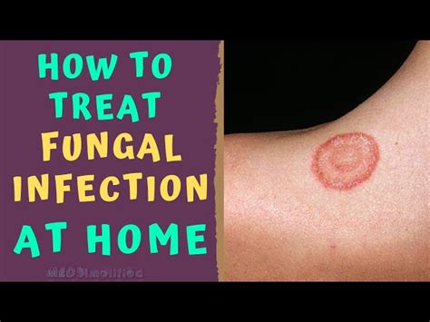 Fungal Skin Rash Treatment