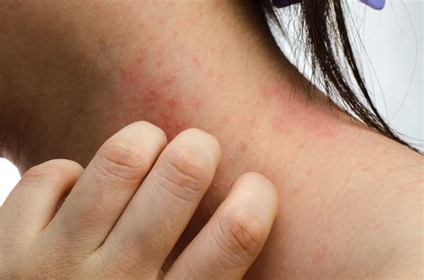 Methotrexate Treatment Improves Symptoms Of Severe Atopic Dermatitis The Clinical Advisor