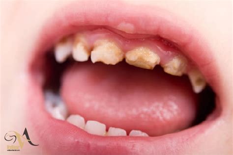 پوسیدگی دندان کودک 18 ماه تا 4 سال علائم، جلوگیری، درمان ولیعصر دنتال