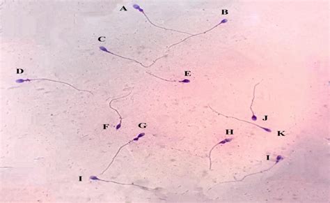 The Evaluation Of The Sperm Deformity Index Sdi Using Giemas Stain The Evaluation Of The Sperm Deformity Index Sdi Using Giemas Stain