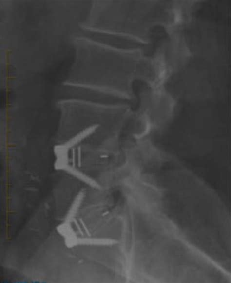 Lumbar Adjacent Segment Disease Spine Orthobullets