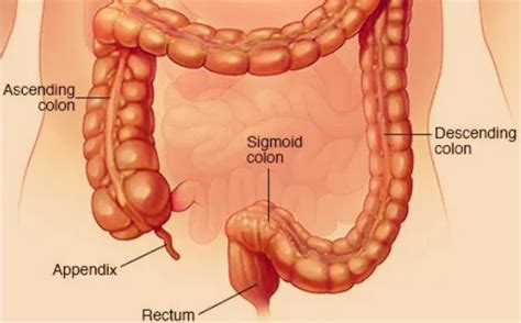 Types Of Colectomy Medisuggest