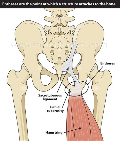 Hamstring Injuries Caring Medical