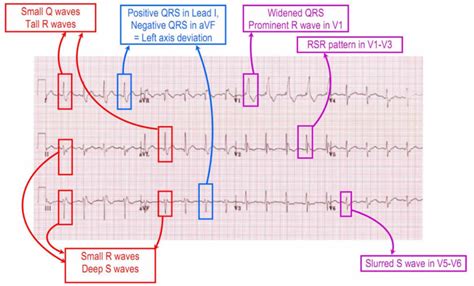 Bifascicular Block Causes Symptoms Diagnosis And Treatment