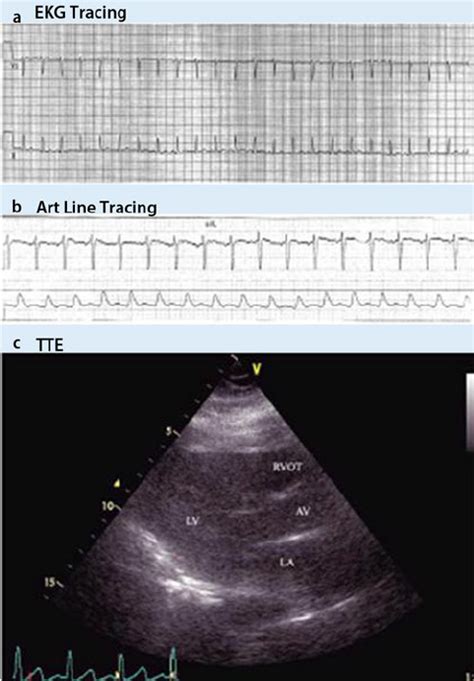 8 During Cardiac Tamponade A Electrocardiogram Tracing Reveals Low Download Scientific Diagram