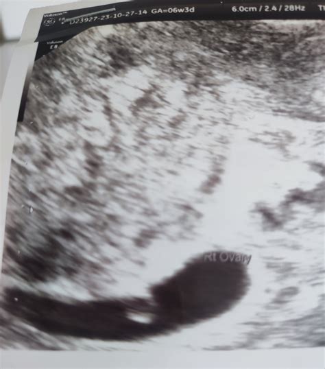 Разчитане на снимка от ехограф Бъдещи майки Страница 13 Мнения от Bg Mamma