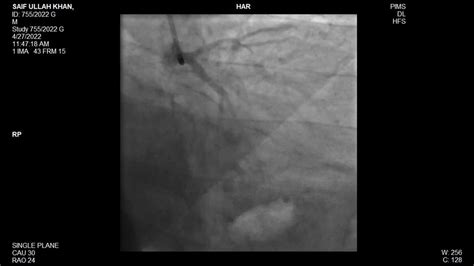 Significant Lesions In Mid Lad Large First Diagonal And Major Om Vid 2 Youtube
