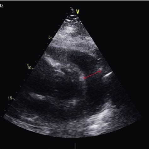 Cardiac Echocardiography Short Axis View Showing Large Pericardial