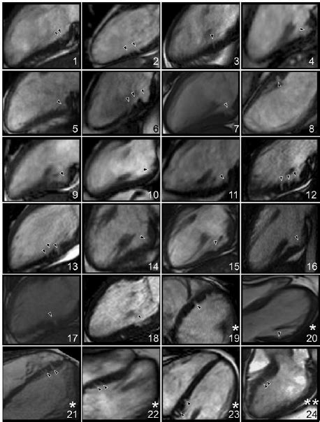 Myocardial Crypts Black Carets By Cardiovascular Magnetic Resonance