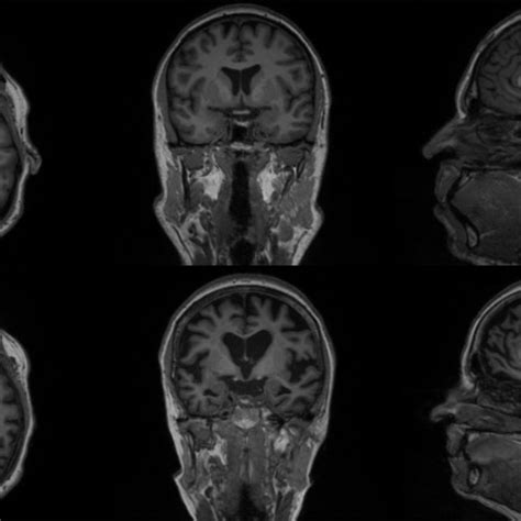 3 Multi Shell Diffusion Mri For A Cognitively Normal Subject Cn Download Scientific Diagram