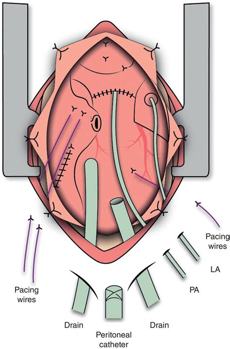 29 Anesthesia For Transposition Of The Great Arteries Anesthesia Key