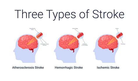 Premium Vector Ischemic Stroke Diseases Stage Anatomy Diagram Vector Illustration