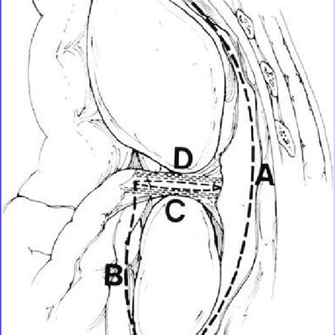Positioning Of The Patient For A Right Sided Laparoscopic Radical Download Scientific Diagram