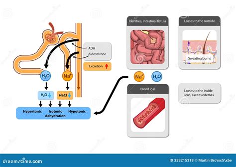 Hypertonic Isotonic And Hypotonic Dehydration Their Causes And The Hormonal Influence On