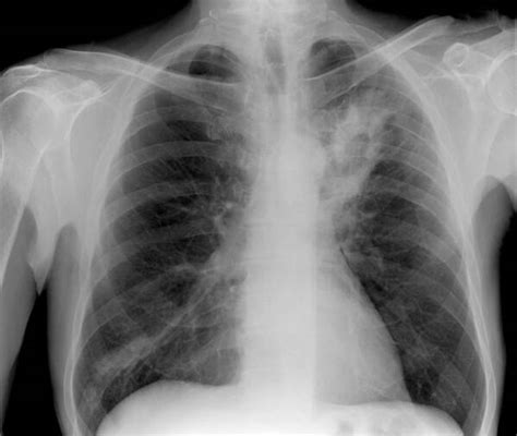 Lung Abscess X Ray