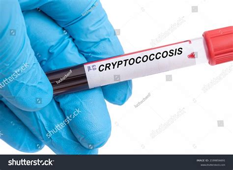 11 Cryptococcosis Test Images Stock Photos Vectors Shutterstock