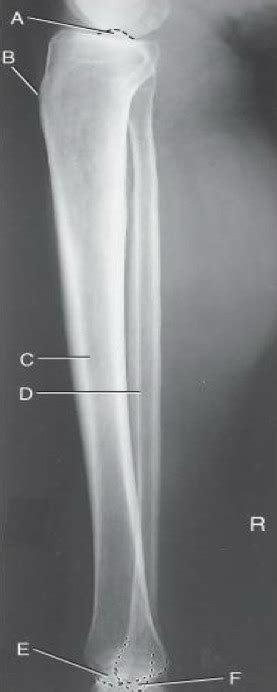 Lateral Tib And Fib Diagram Diagram Quizlet