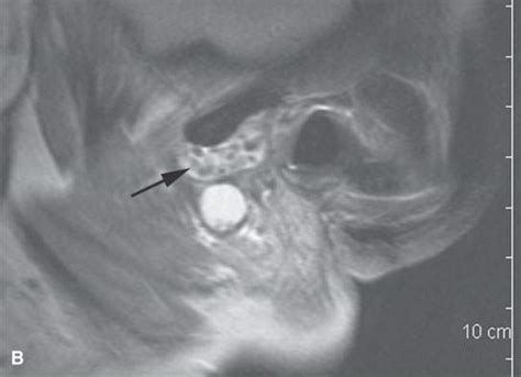 Calcification Ossifications Matrices Radiodense Foreign Bodies And