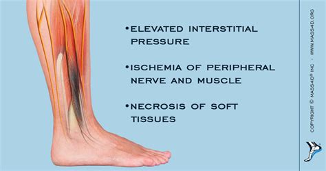 Anatomy Of Compartment Syndrome