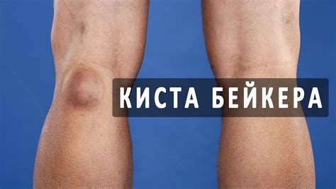 Боль под коленом сзади причины почему болит нога при ходьбе чем лечить