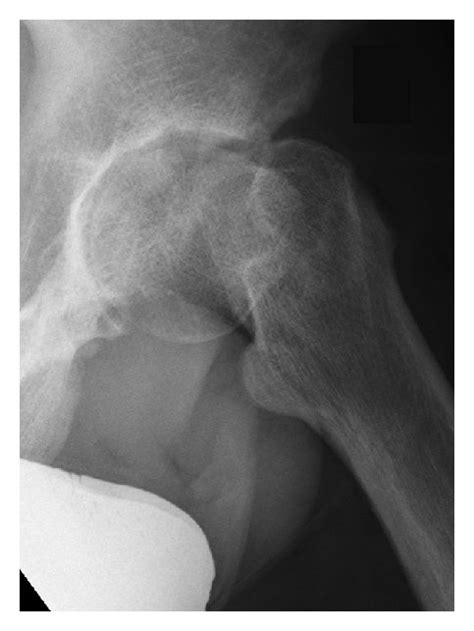 Standard Pelvic Radiograph Showing Bilateral Pseudarthrosis Of The Download Scientific Diagram