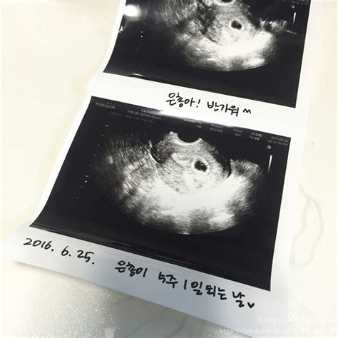 임신 5주차 증상 아기집 초음파 확인 입덧 먹덧 시작 네이버 블로그