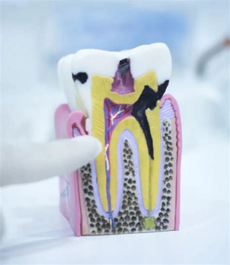 Endodoncija Dentalcentarrs Gentle Touch