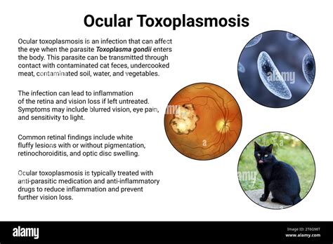 Ocular Toxoplasmosis A Disease Caused By The Single Celled Protozoan Toxoplasma Gondii
