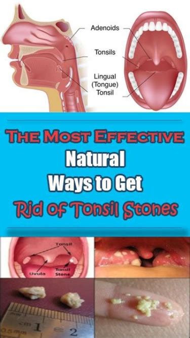 Top 8 Home Remedies To Remove Tonsil Stones Artofit