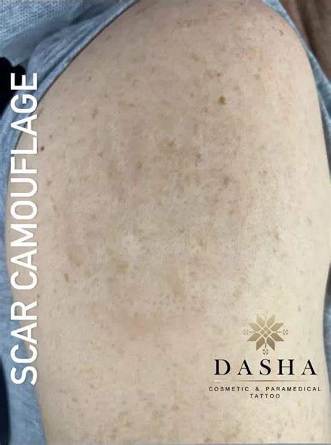 Branding Scar Skin Camouflage Cosmetic And Medical Tattoo By Dasha